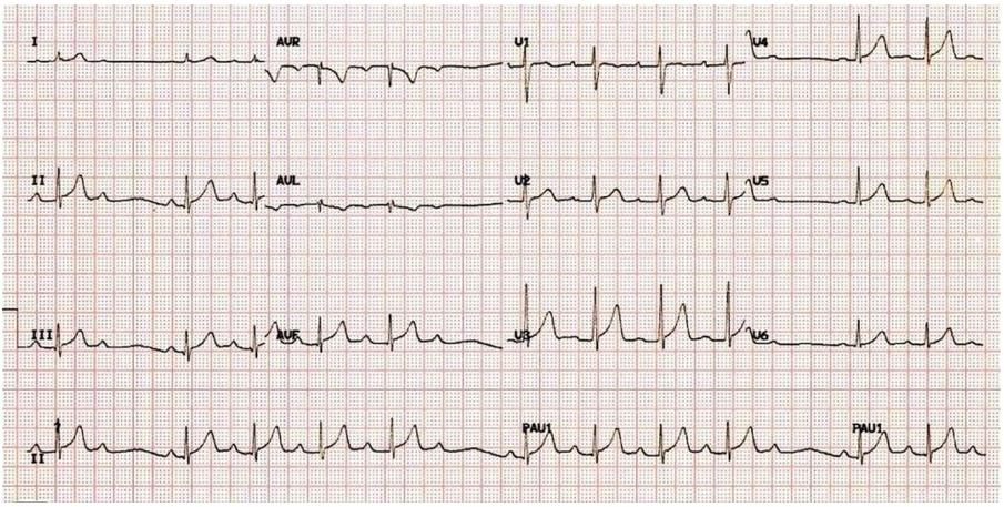 ECG Interpretation